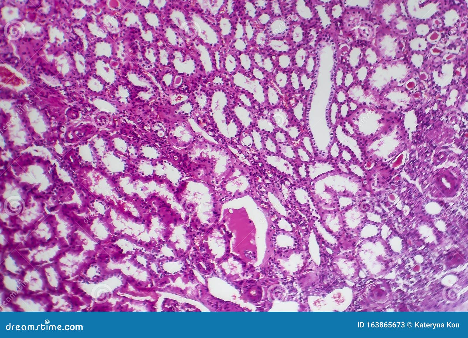 Tubular Atrophy, Light Micrograph Stock Image - Image of tissue ...