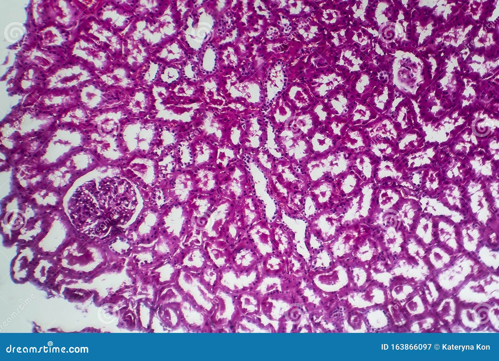 Tubular Atrophy, Light Micrograph Stock Image - Image of microscopic ...