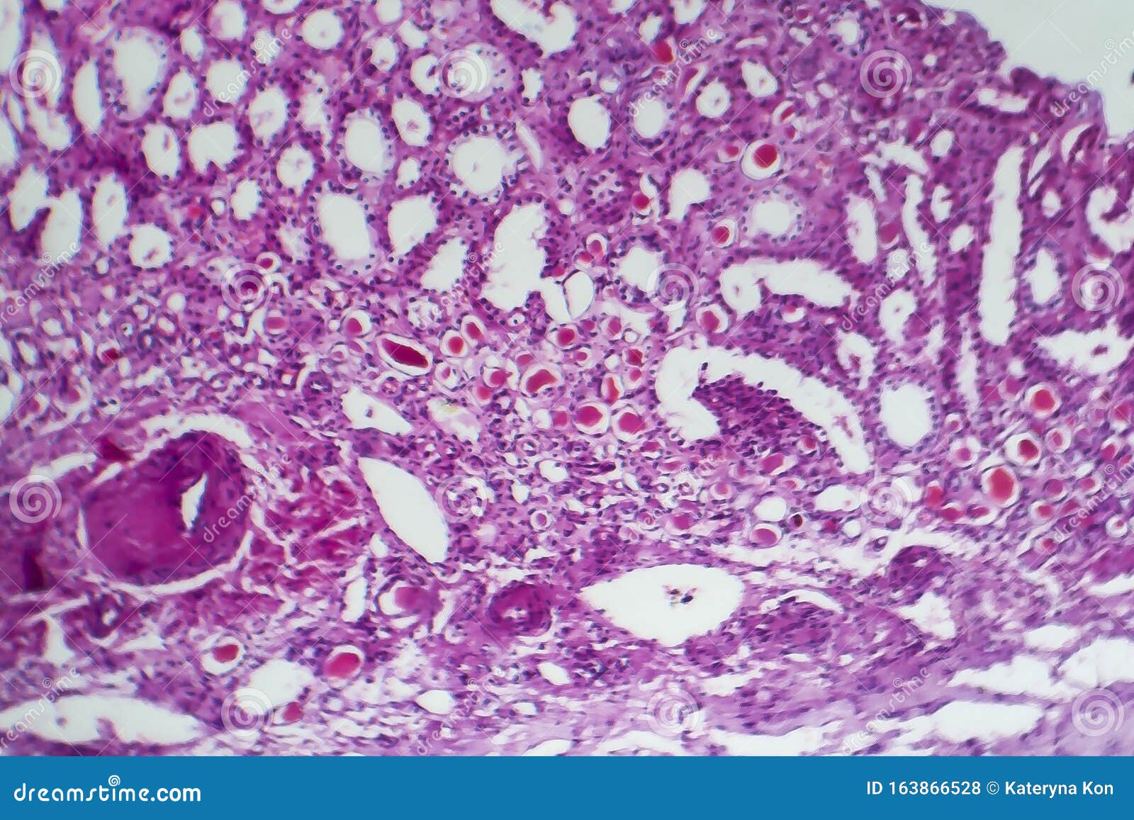 Tubular Atrophy, Light Micrograph Stock Photo - Image of renal ...