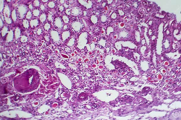 Tubular Atrophy, Light Micrograph Stock Photo - Image of renal ...