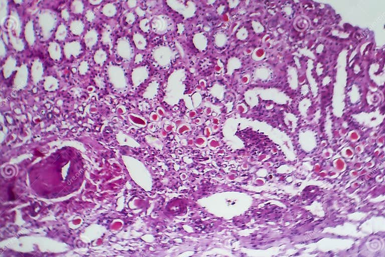 Tubular Atrophy, Light Micrograph Stock Photo - Image of renal ...