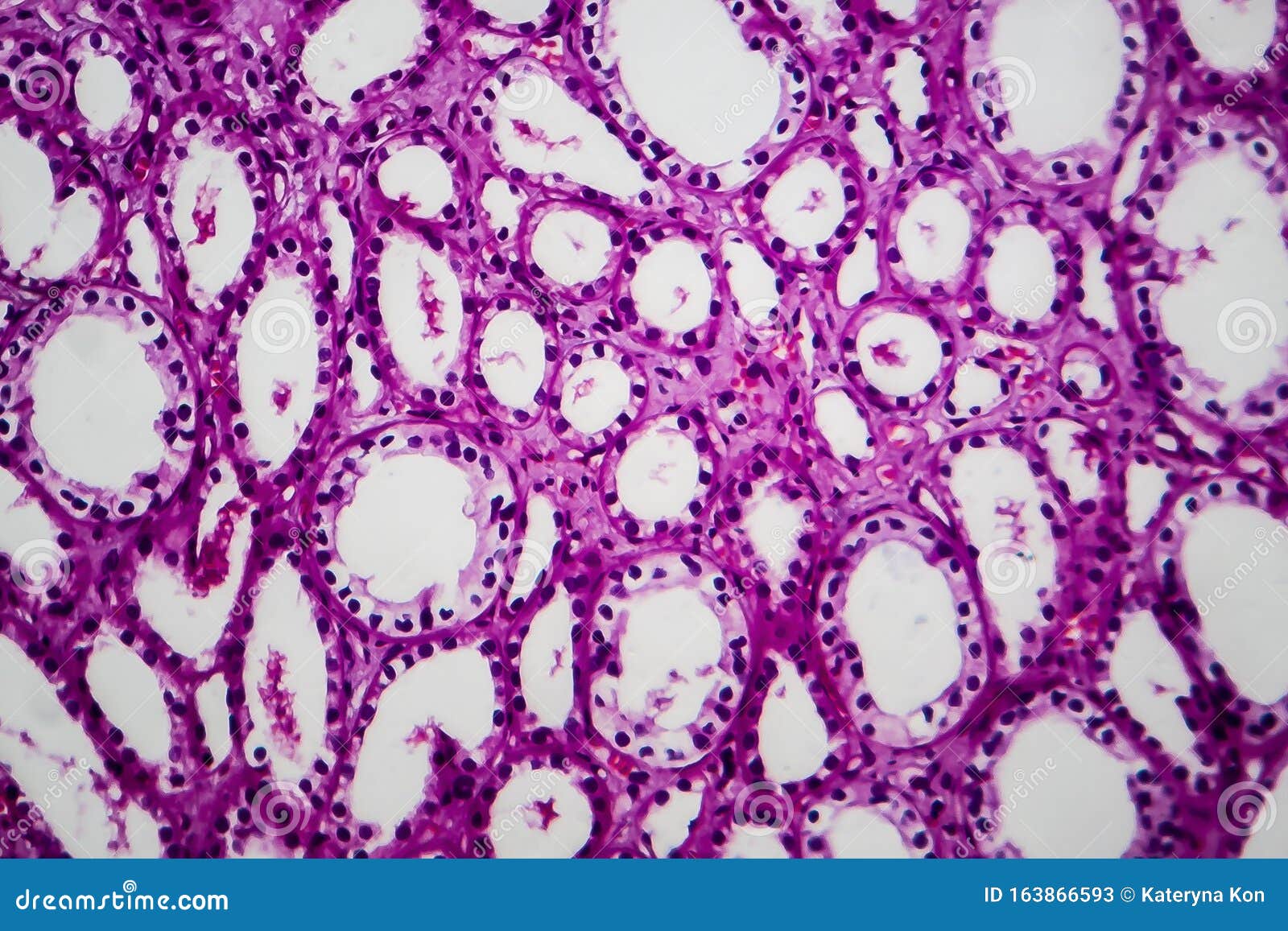 Tubular Atrophy, Light Micrograph Royalty-Free Stock Photography ...