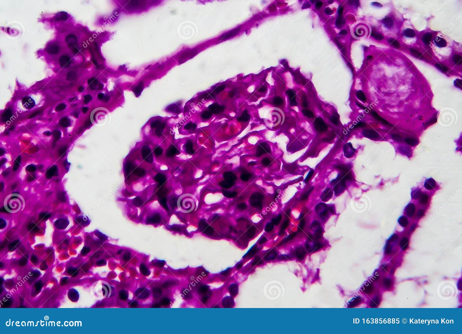 Tubular Atrophy, Light Micrograph Royalty-Free Stock Photography ...