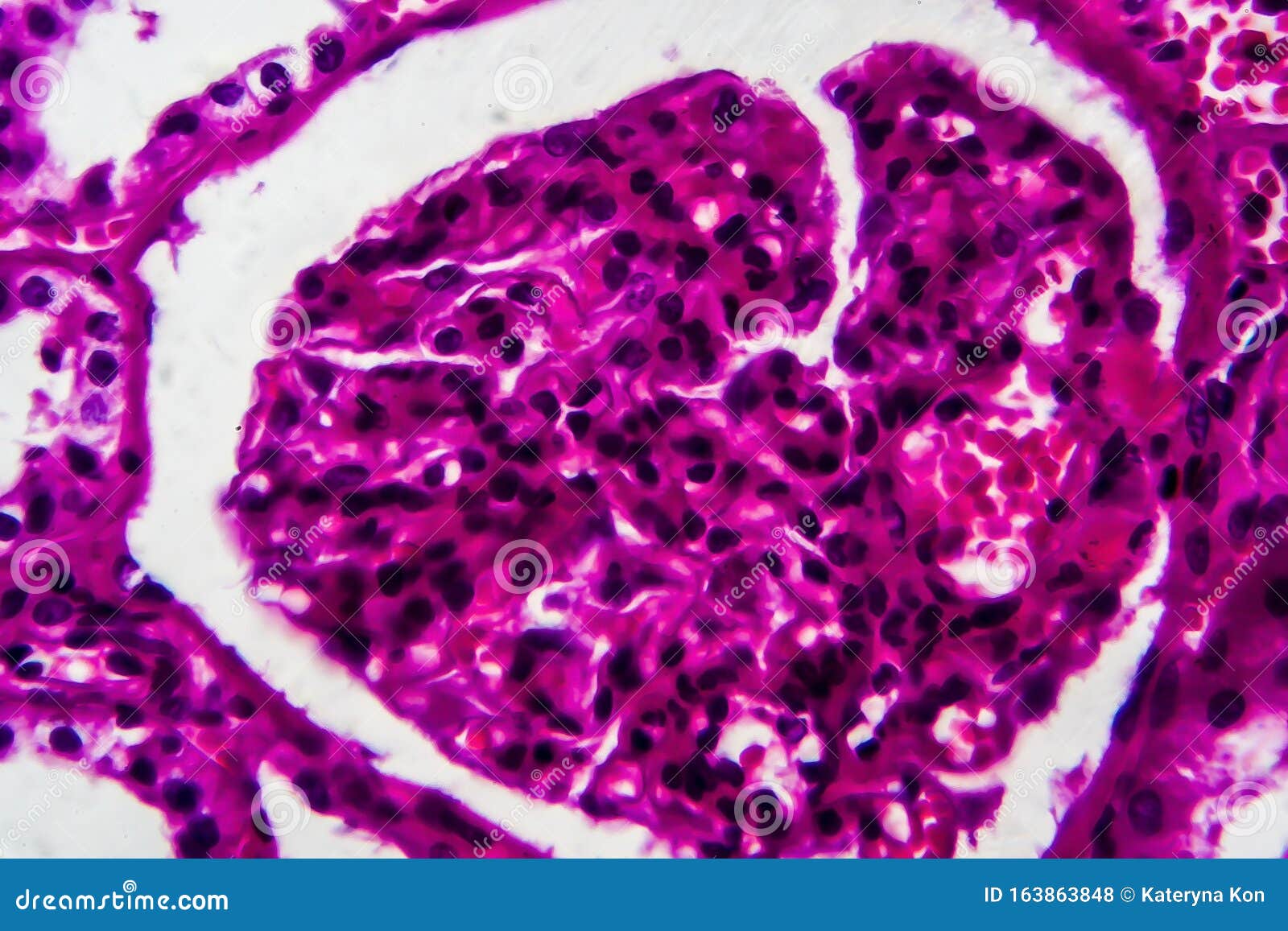 Tubular Atrophy, Light Micrograph Stock Photo - Image of injury ...