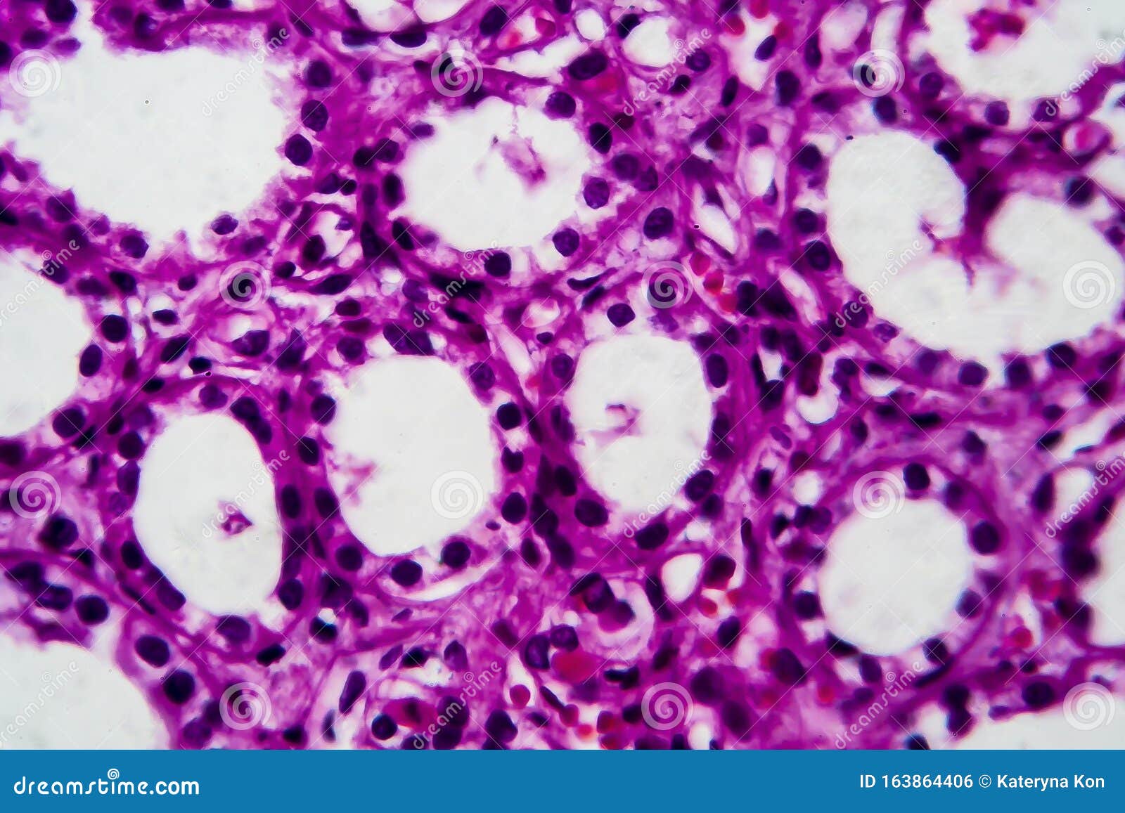 Tubular Atrophy, Light Micrograph Stock Photo - Image of cell ...