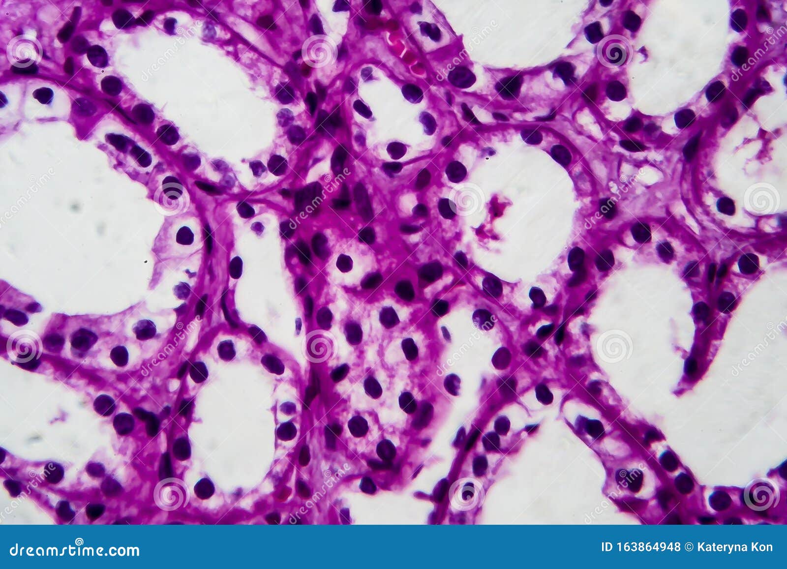 Tubular Atrophy, Light Micrograph Stock Photo - Image of cell, medical ...