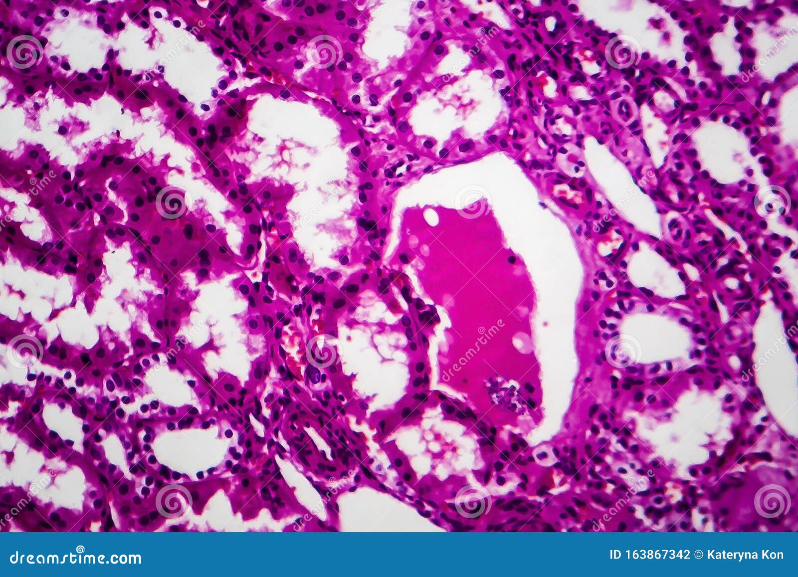 Tubular Atrophy, Light Micrograph Stock Photo - Image of microscope ...