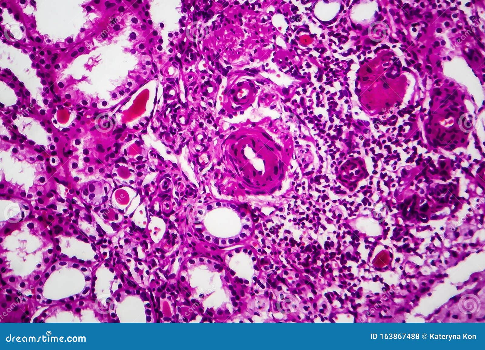 Tubular Atrophy, Light Micrograph Stock Photo - Image of renal ...