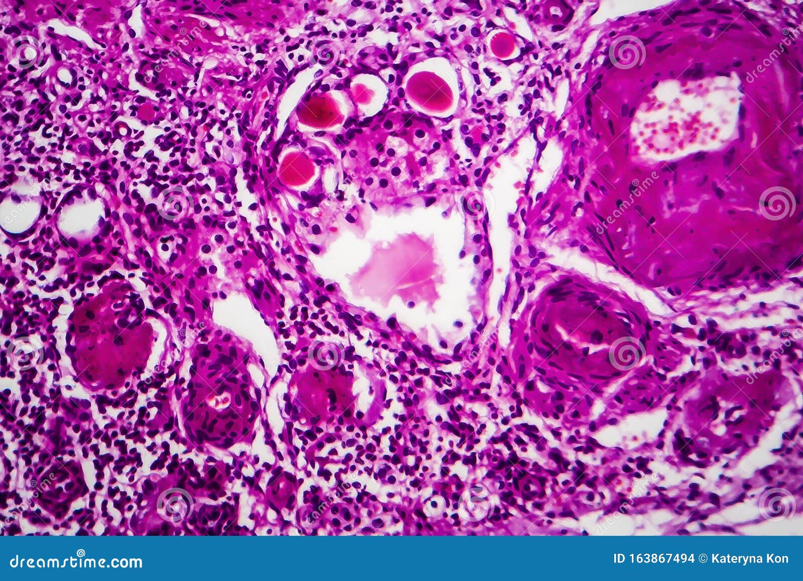 Tubular Atrophy, Light Micrograph Stock Photo - Image of micrograph ...