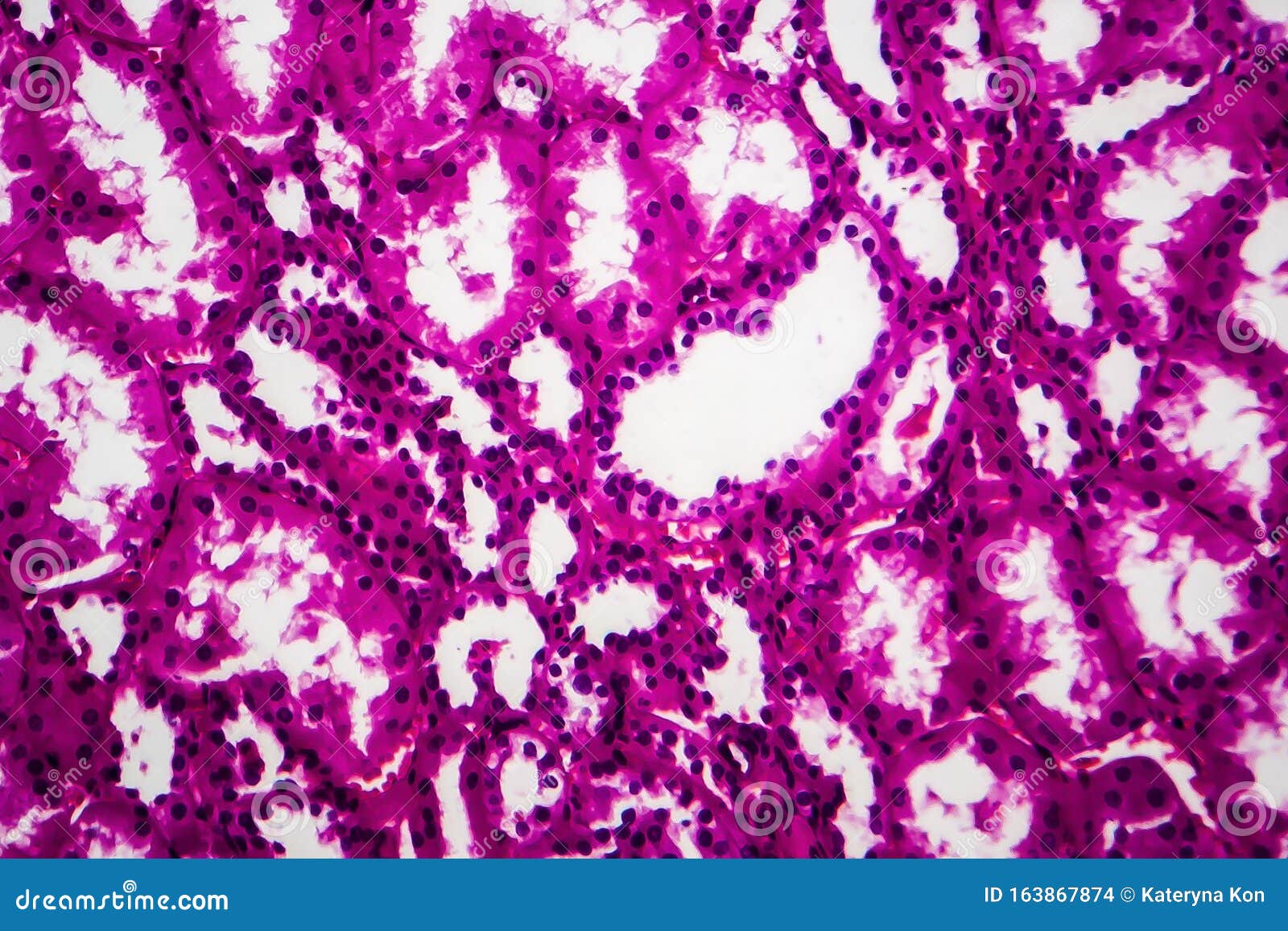 Tubular Atrophy, Light Micrograph Stock Photo - Image of micrograph ...