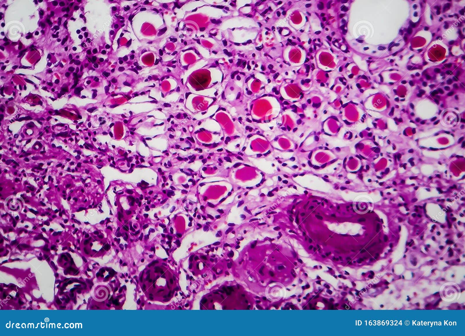 Tubular Atrophy, Light Micrograph Stock Photo - Image of micrograph ...