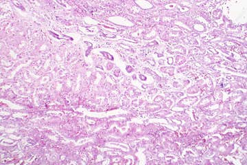 Tubular epithelial edema stock photo. Image of edema - 121506496