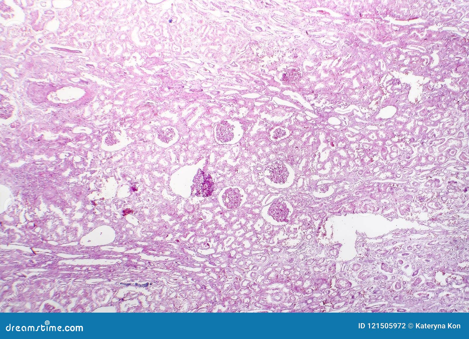 Tubular epithelial edema stock photo. Image of microscope - 121505972