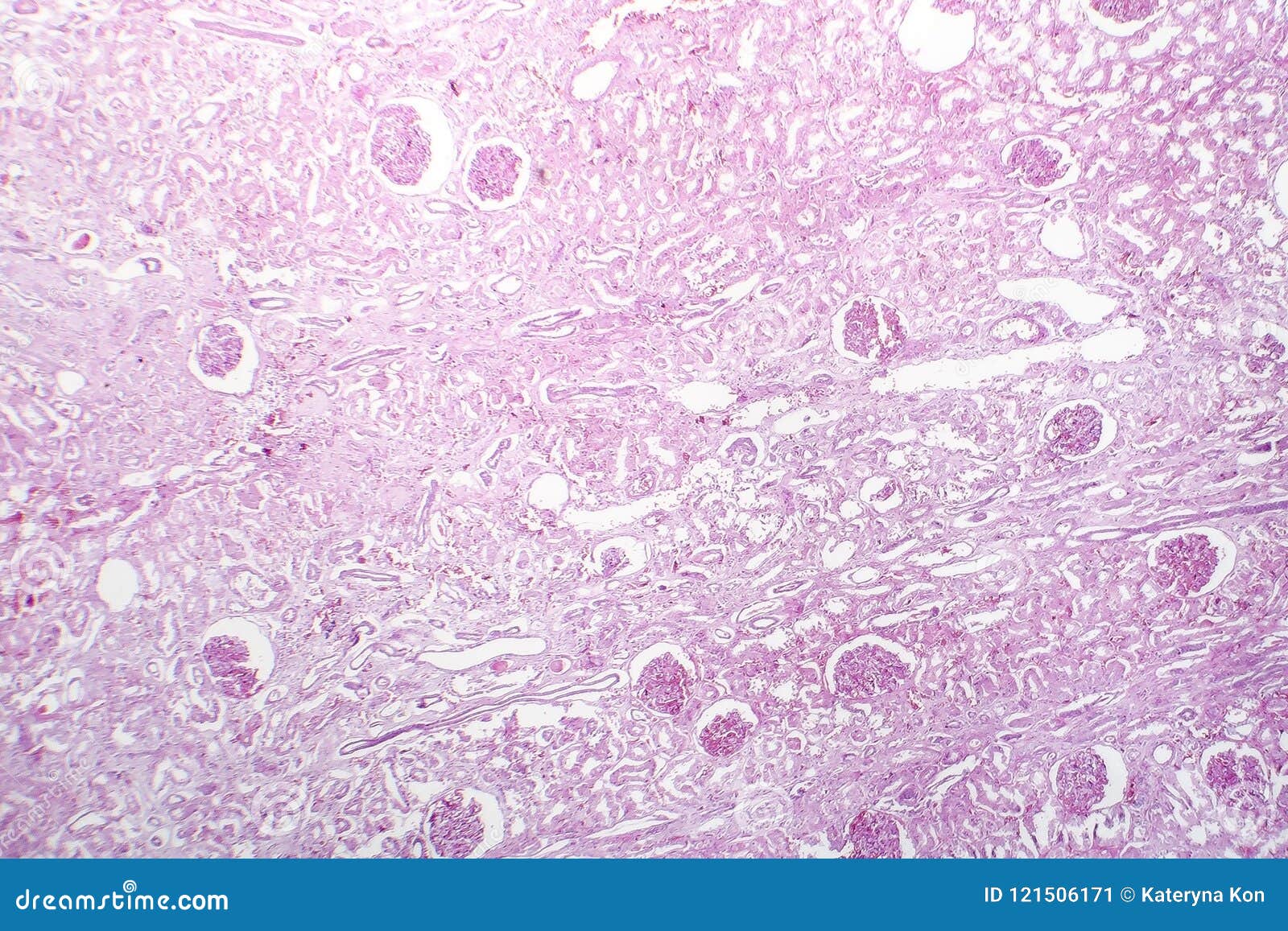 Tubular epithelial edema stock image. Image of kidney - 121506171