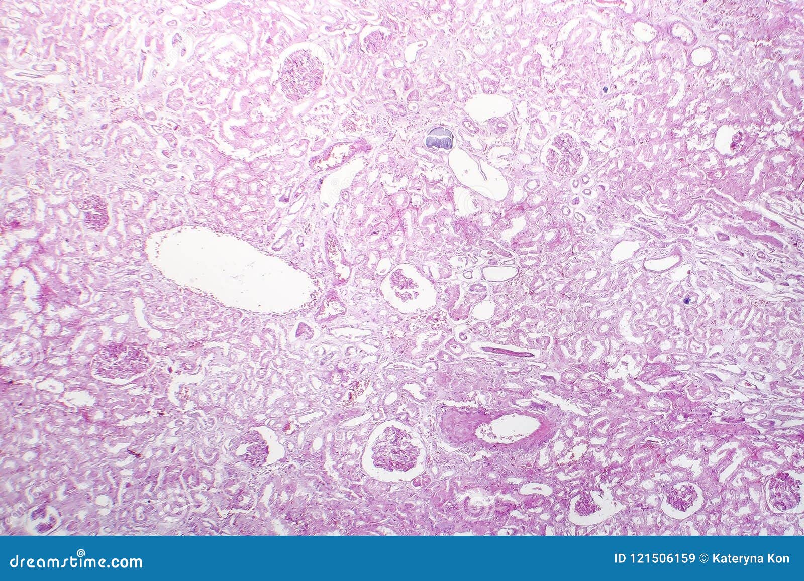 Tubular epithelial edema stock image. Image of microscopy - 121506159