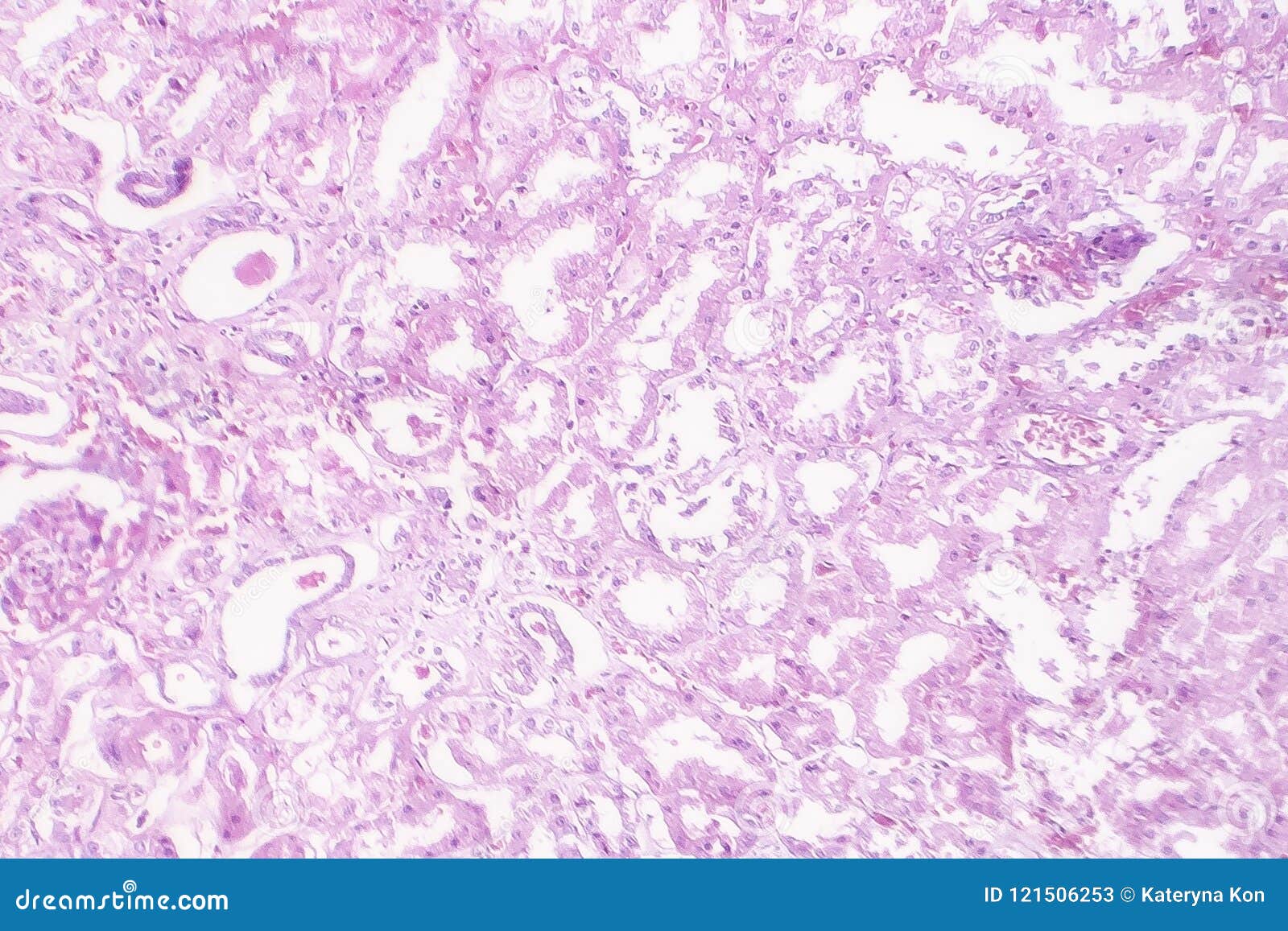 Tubular epithelial edema stock image. Image of renal - 121506253