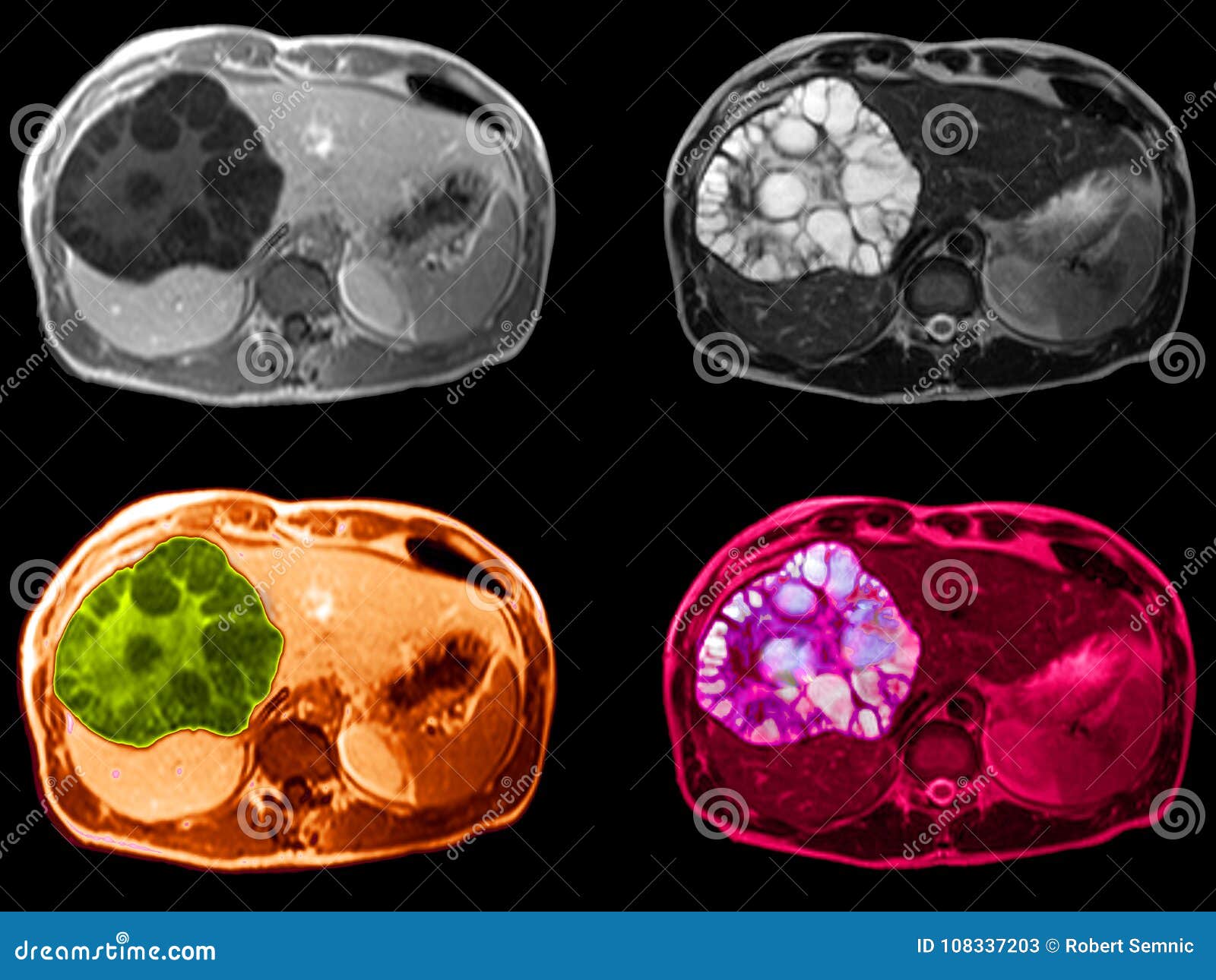 Tumor Del Hígado, SR. Imagen Imagen de archivo - Imagen de quiste ...