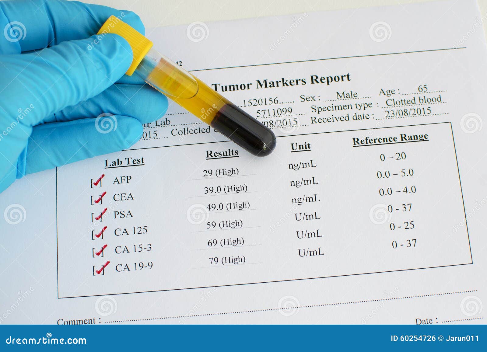 Tumor marker results stock photo. Image of illness, alfa - 60254726 Tumor marker results stock photo. Image of illness, alfa - 60254726