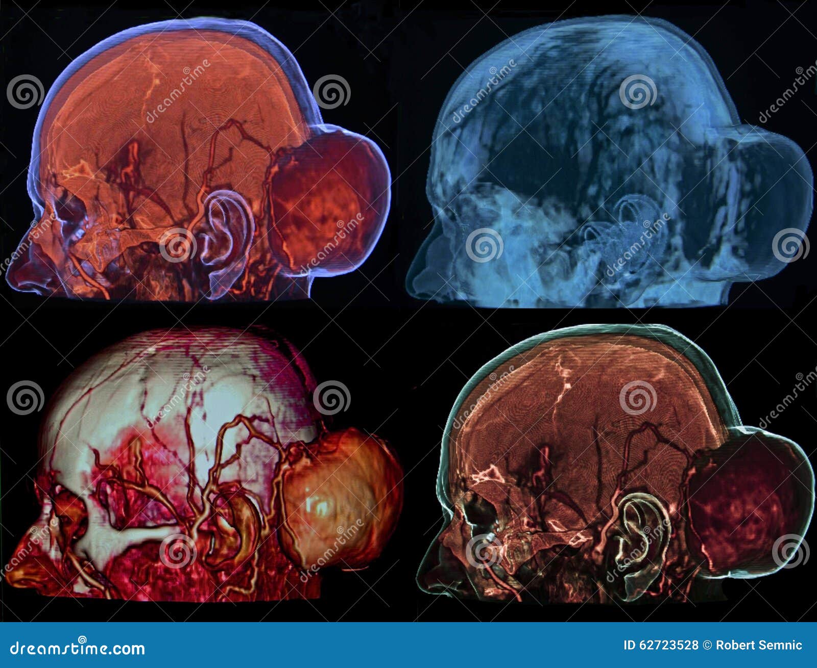 Tumore Del Cranio, CT Dell'osso Fotografia Stock - Immagine di dolore ...