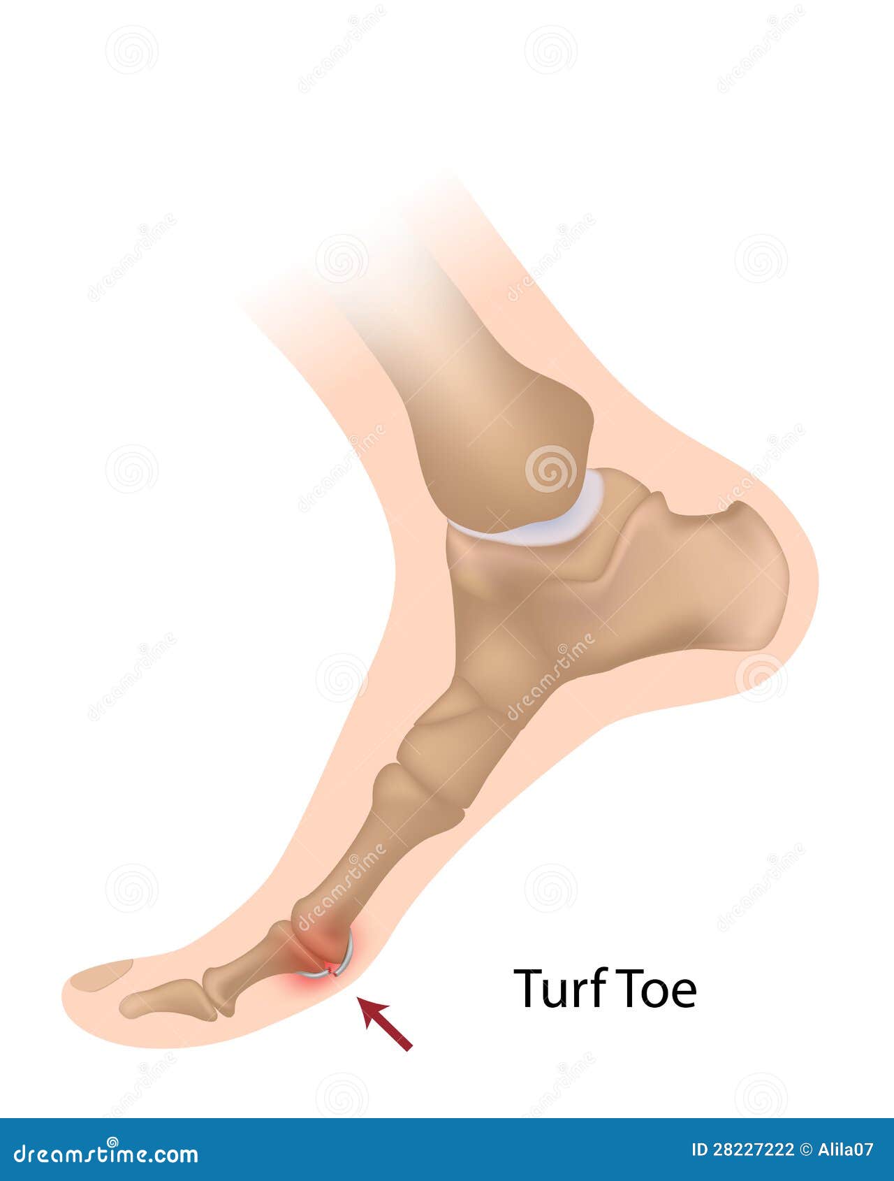 Turf toe stock vector. Illustration of sprain, sport - 28227222