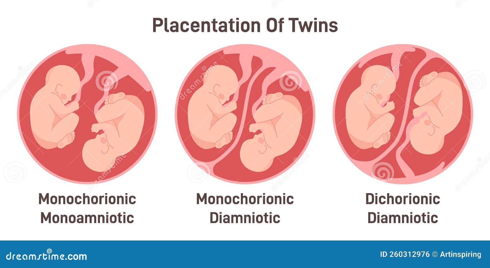 Twin Types Monozygotic Or Dizygotic Placentation Of Twins Monochorionic Stock Vector