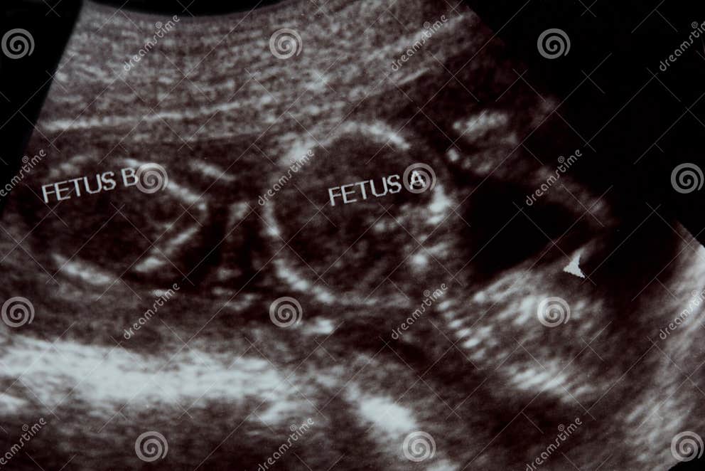 Twins USG scan results. stock photo. Image of close, checking - 21265518
