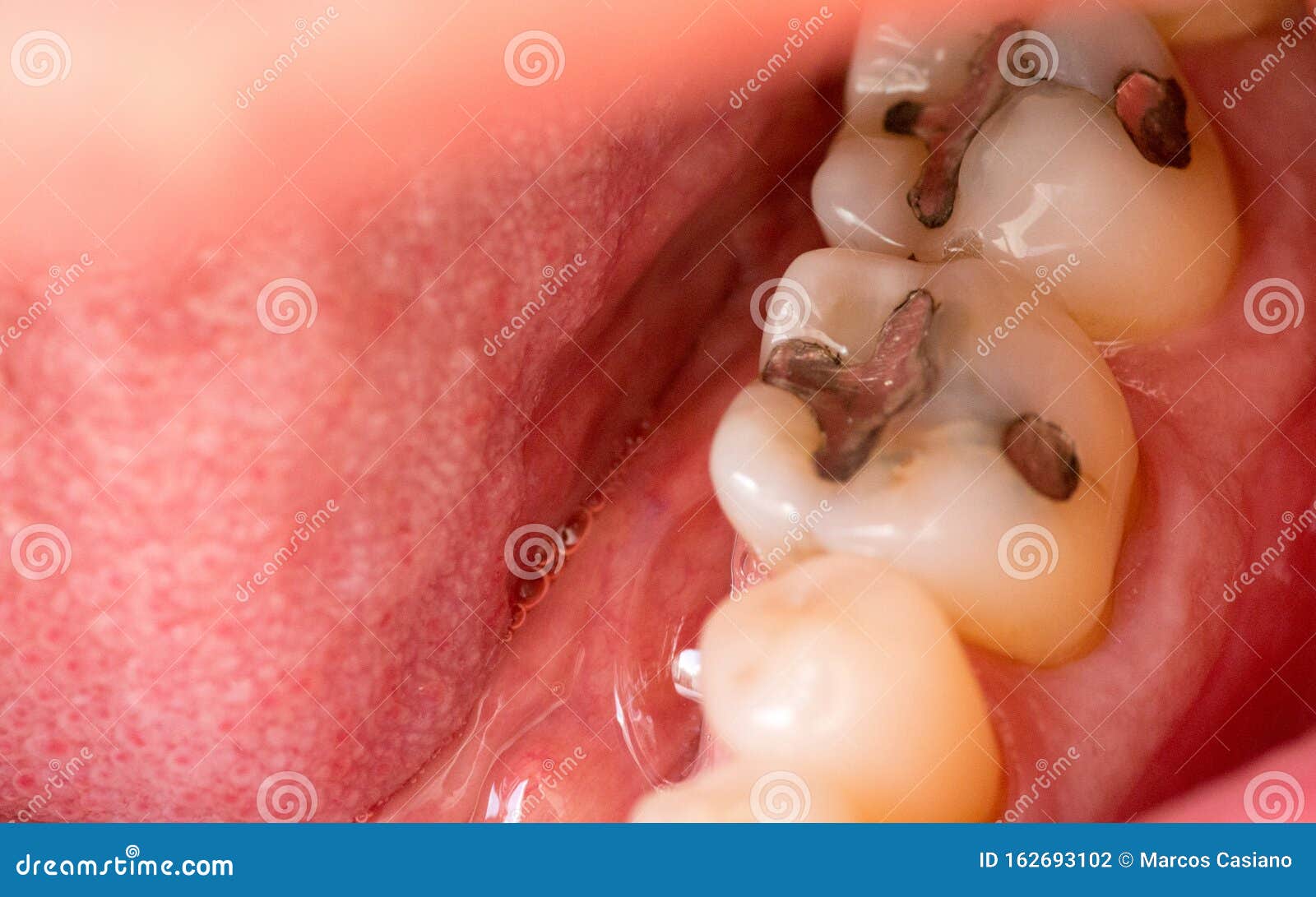 Two Back Molars With Metal Fillings Royalty-Free Stock Photo ...