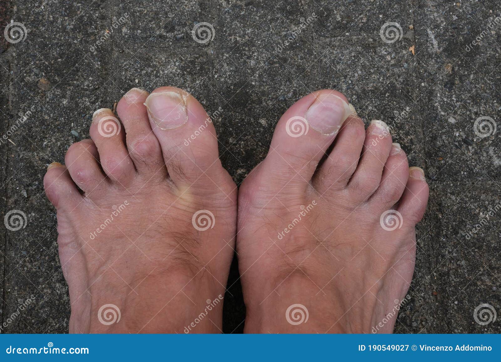 Two Feet with Hooked Toes,on a Sidewalk. Concept of Small Deformation ...