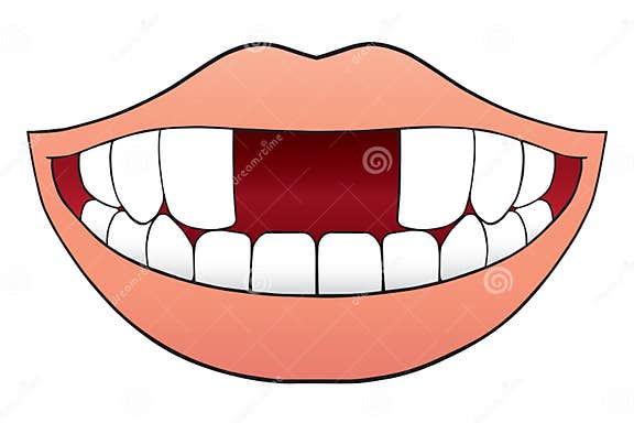 Two Front Teeth Missing stock vector. Illustration of bony - 98168774