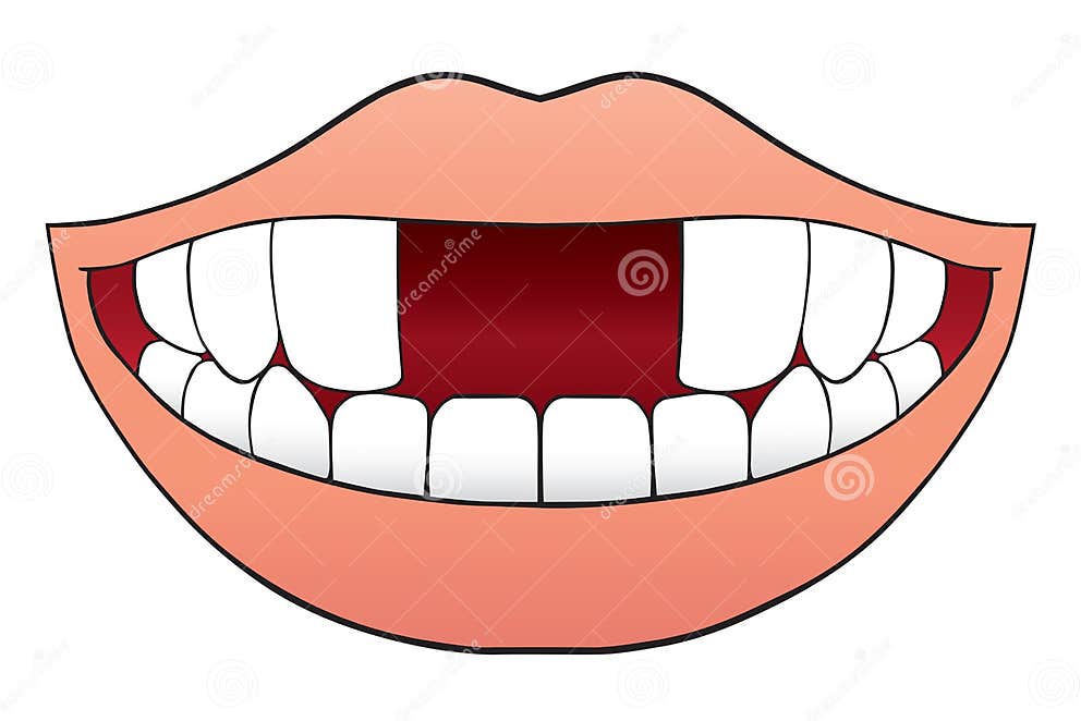 Two Front Teeth Missing stock vector. Illustration of bony - 98168774