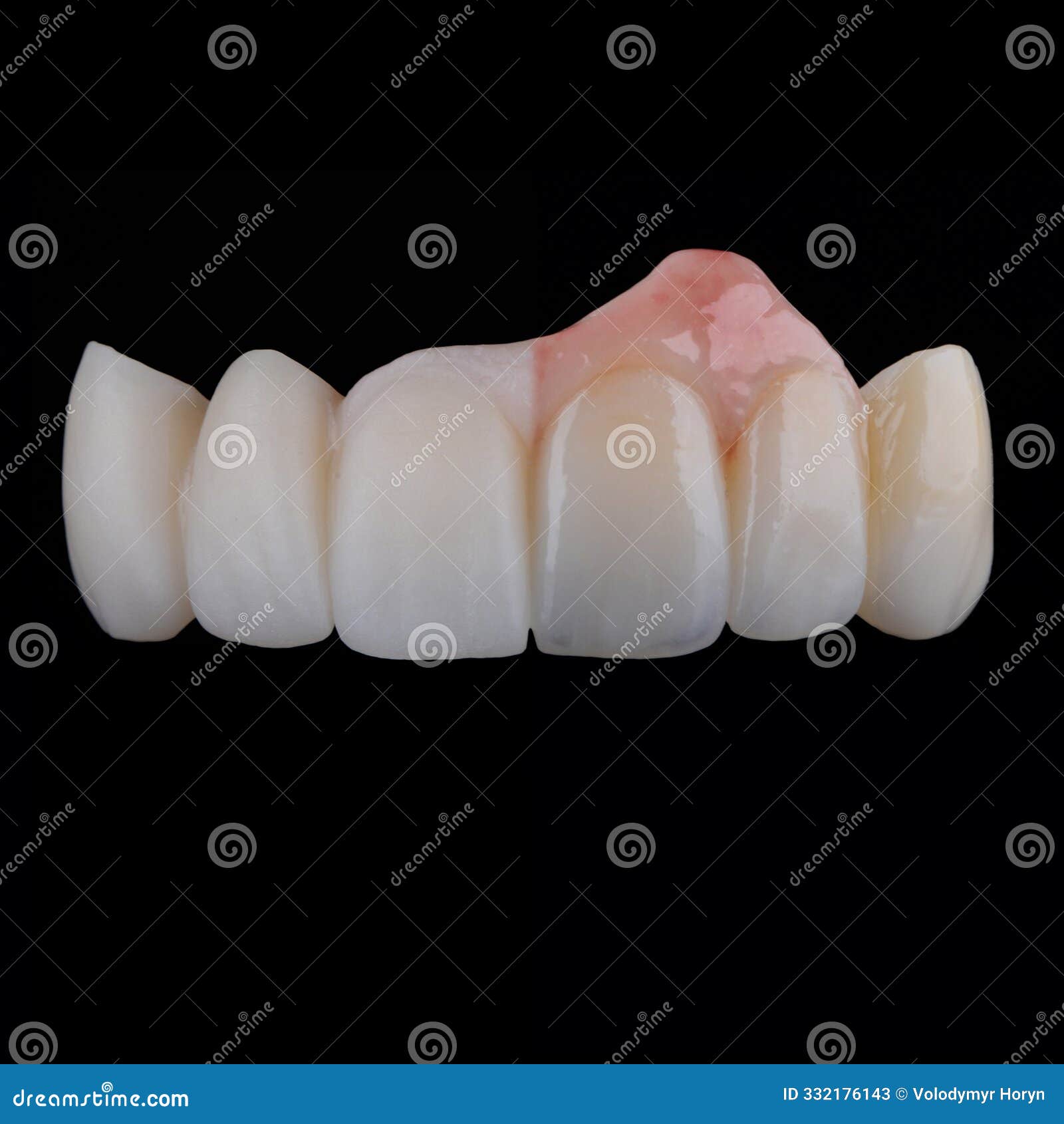 Two Halves before and after Staining of a Monolithic Dental Bridge with ...