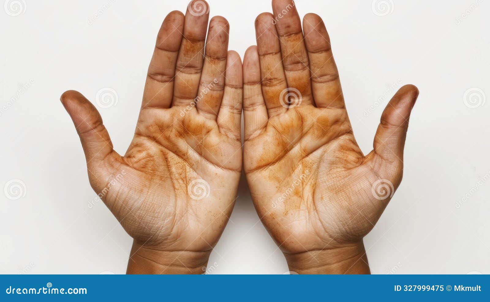 Hands Displaying Skin Condition with Harmful Effects in Natural Light ...