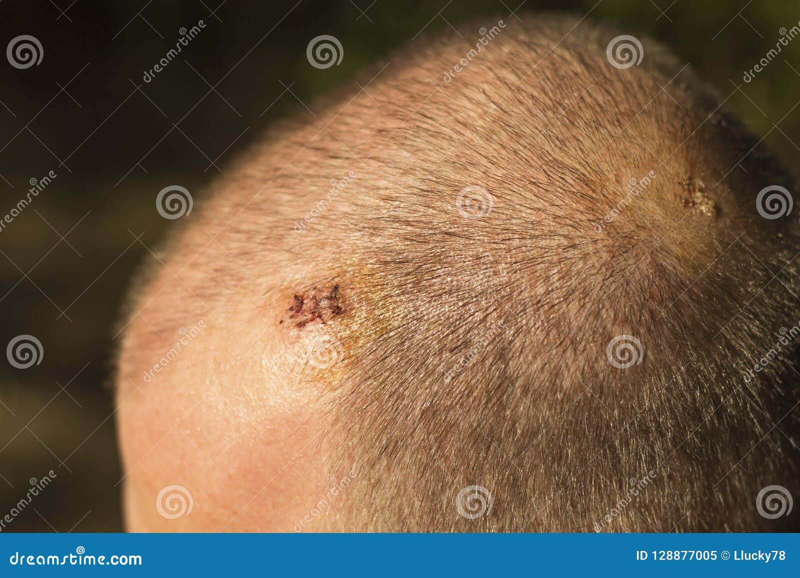 Two Scars after Removing Fat Tissue from Head Stock Image - Image of ...