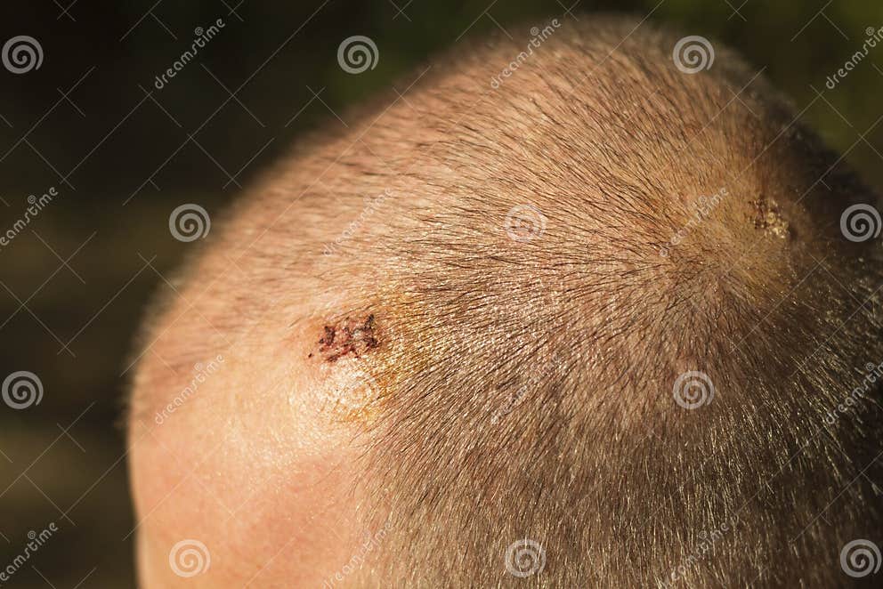 Two Scars after Removing Fat Tissue from Head Stock Image - Image of ...
