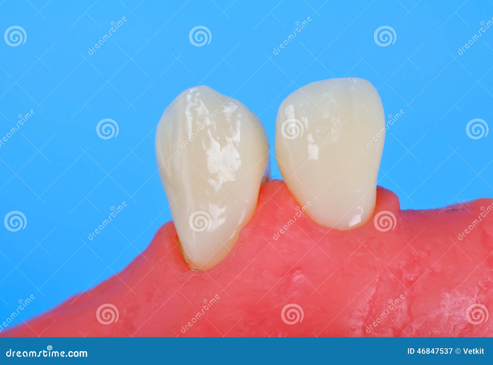Two tooth stock image. Image of dentistry, prosthesis - 46847537