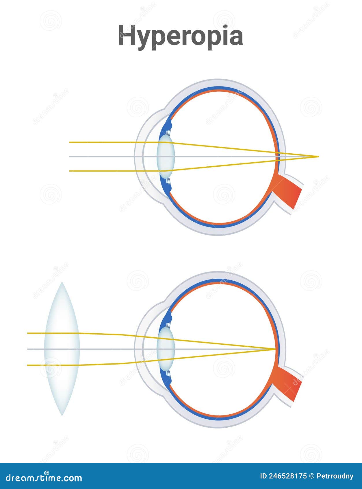 Hyperopia, Farsightedness Eye Disorder, and Corrected Eye by a Plus ...
