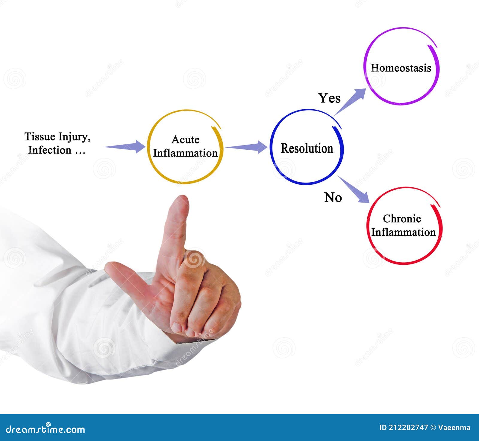 Ways of Resolution of Acute Inflammation Stock Image - Image of ...