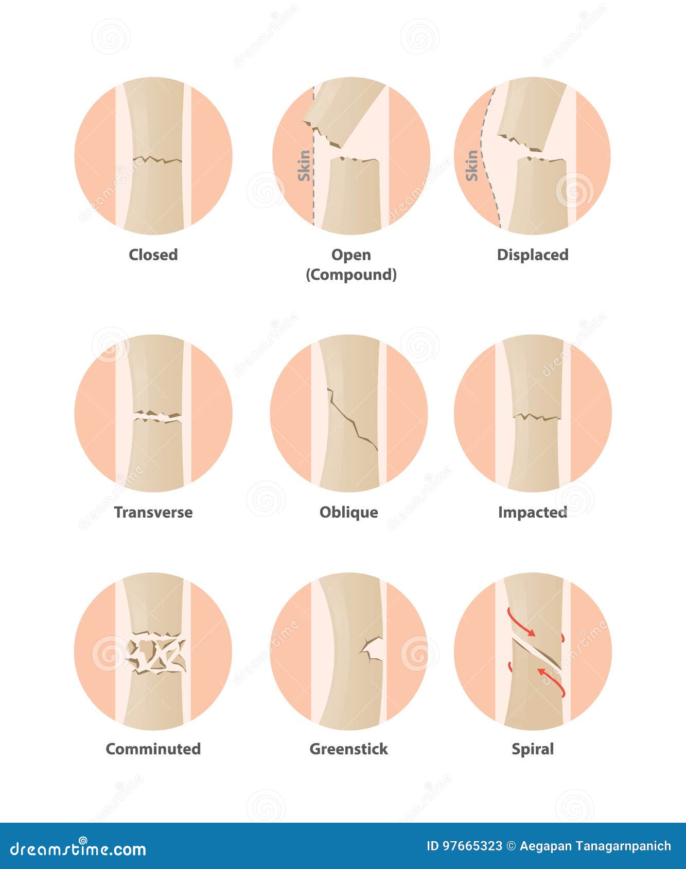 Impacted Fracture Bone. Infographics. Vector Illustration On A Lined ...