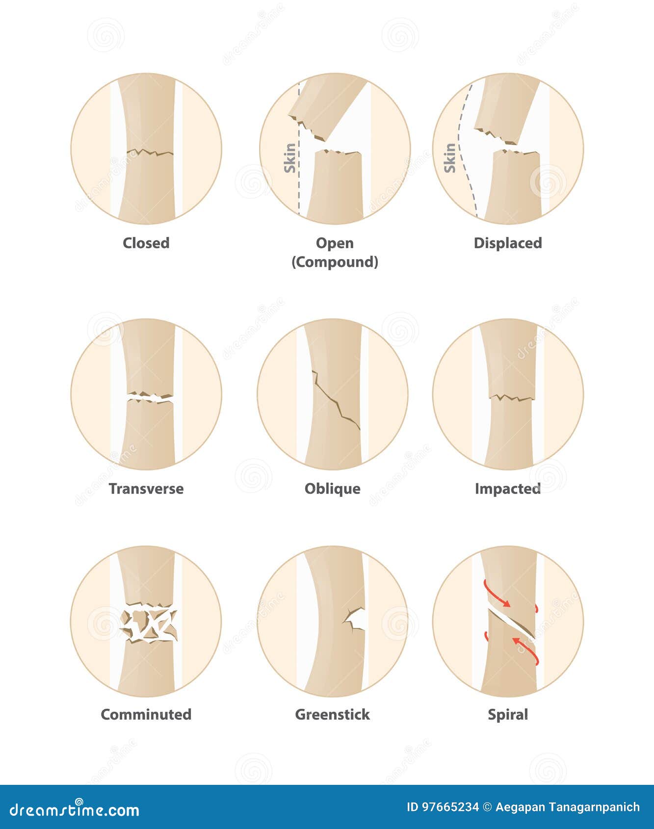 Impacted Fracture Bone. Infographics. Vector Illustration On A Lined ...