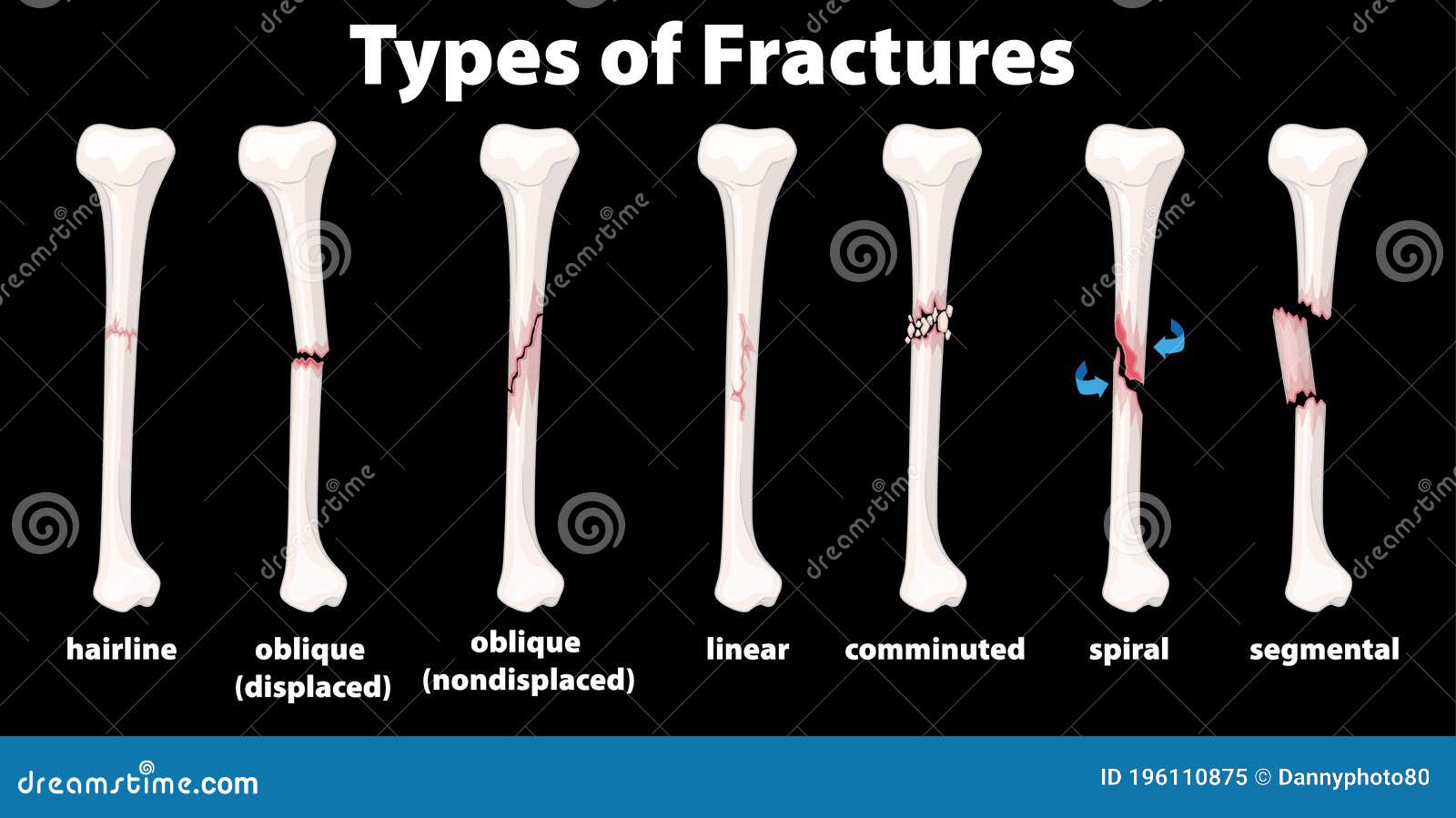Typical Bone Fractures Stock Vector Illustration Of F - vrogue.co Typical Bone Fractures Stock Vector Illustration Of F - vrogue.co