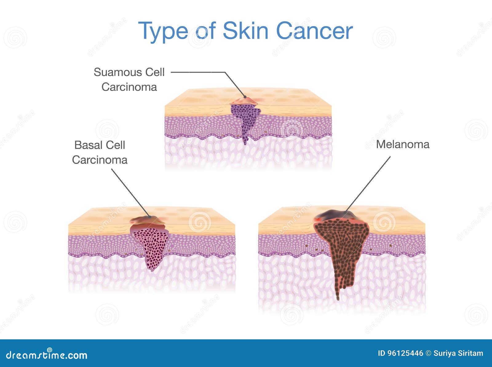 Type Van Huidkanker in 3D Vectorstijl Vector Illustratie - Illustration ...