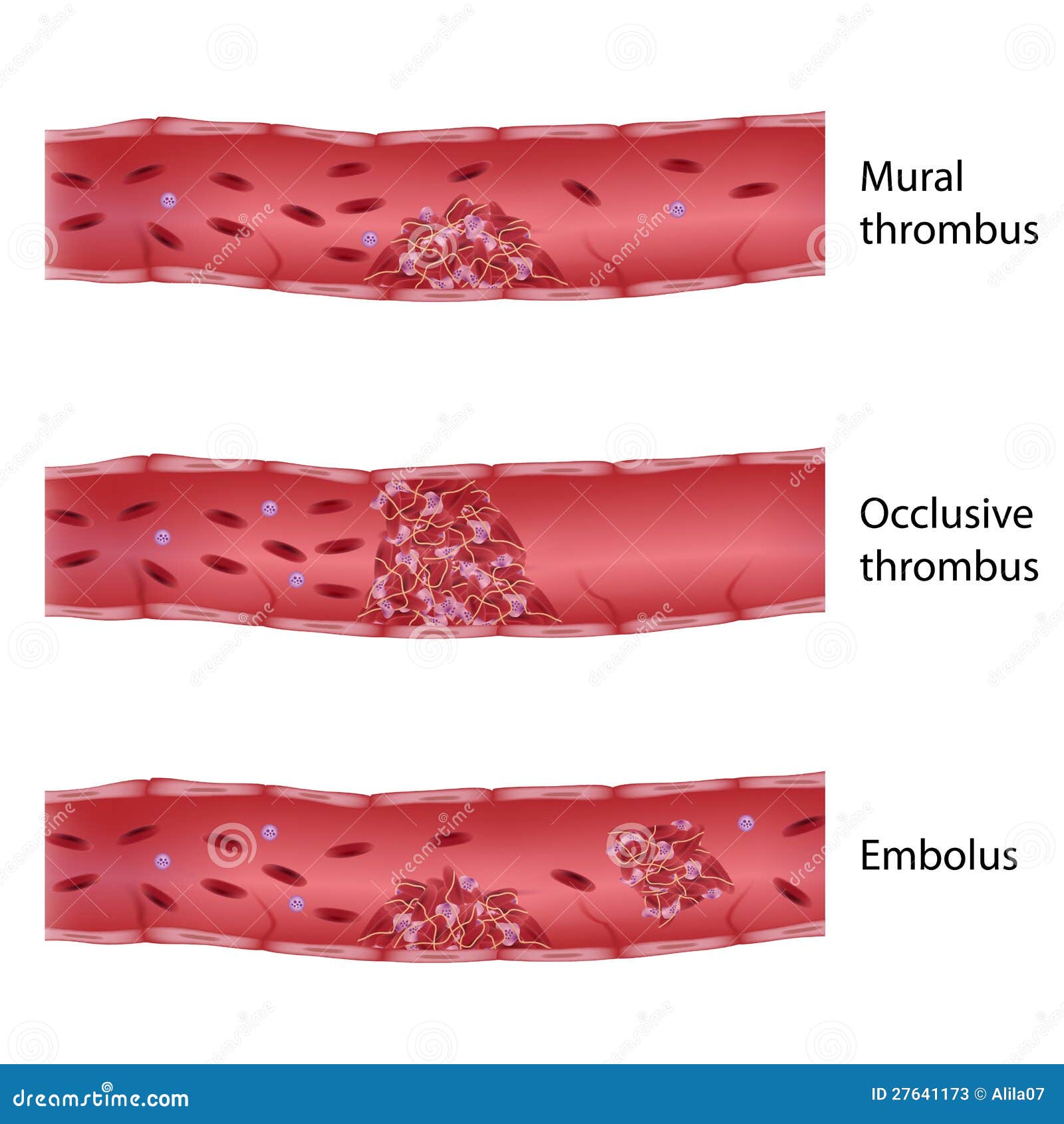 Typen der Thrombose vektor abbildung. Illustration von thrombose - 27641173