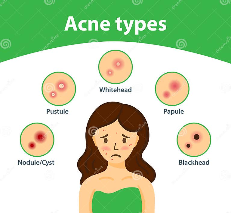 Types Of Acne Causes Of The Disease Treatment Infographics Of Acne
