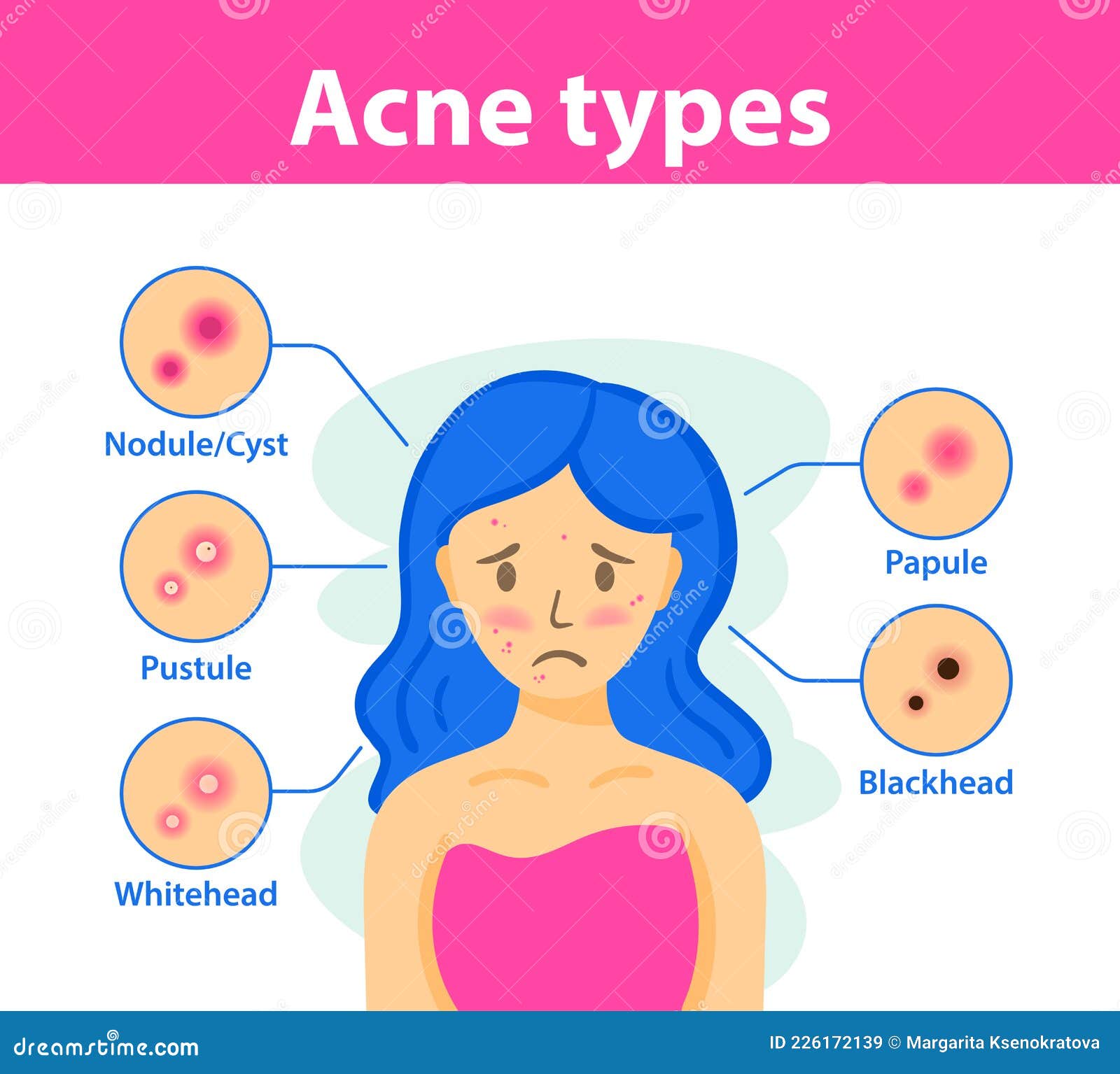 Types Of Acne Causes Of The Disease Treatment Infographics Of Acne