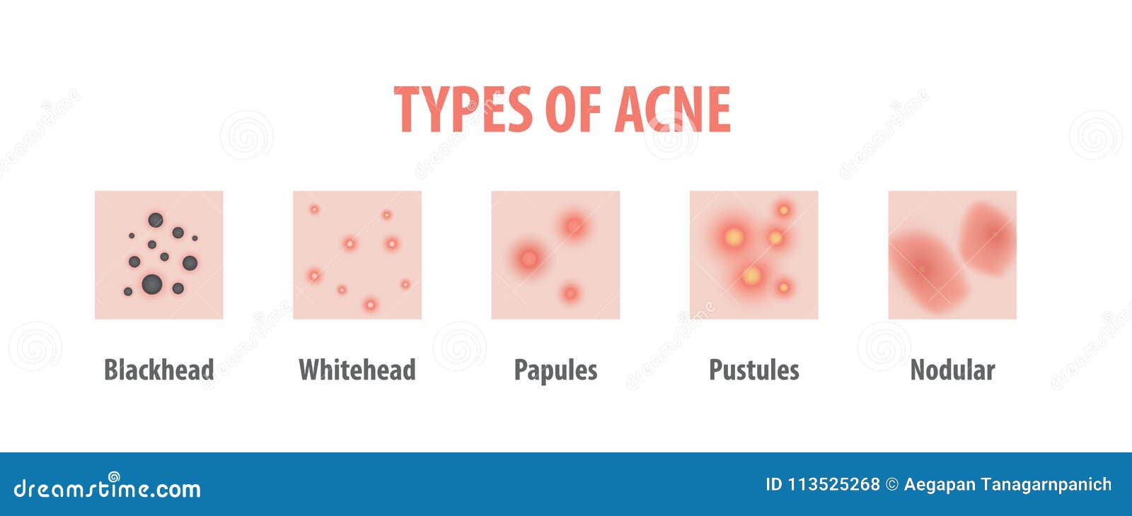 Acne Diagram Illustration With Hair, Pimple, Skin Layers And Structure ...