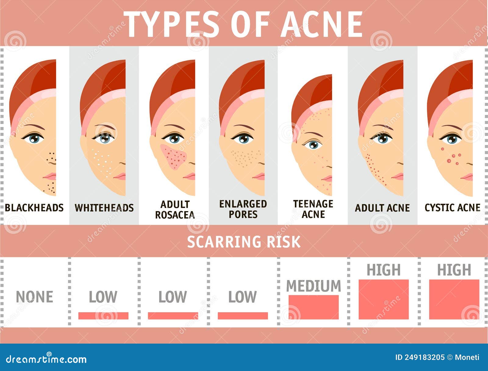 Types Of Acne Infographics Vector Illustration Types Of Acne Pimples
