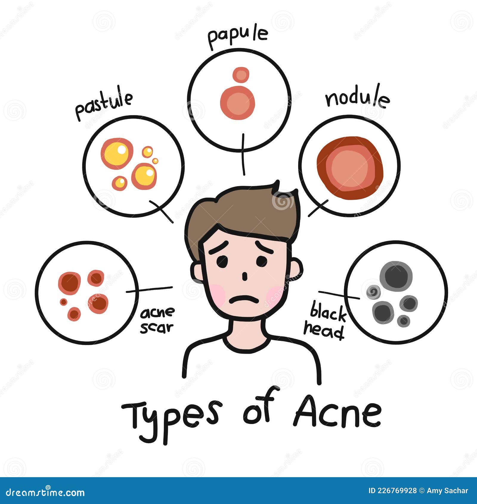 Type of Acne , Cute Man Cartoon Face Illustration Stock Vector ...