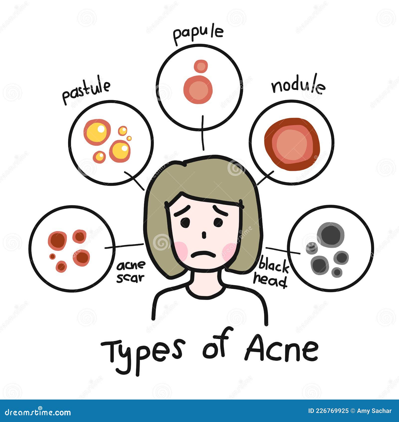 Type of Acne , Cute Woman Cartoon Face Illustration Stock Vector ...