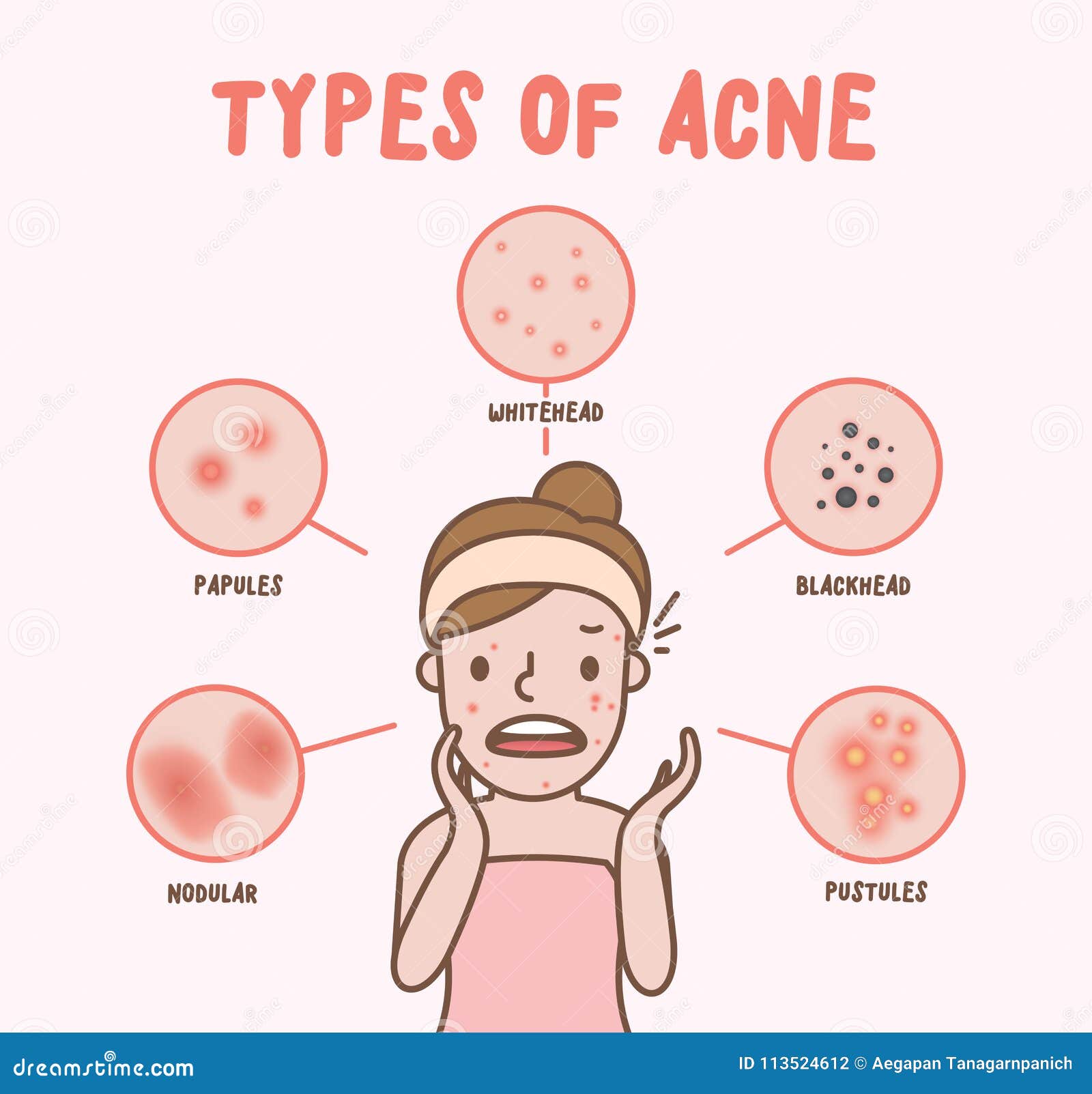 Types Of Acne With Woman Cartoon Illustration Vector On Pink Background