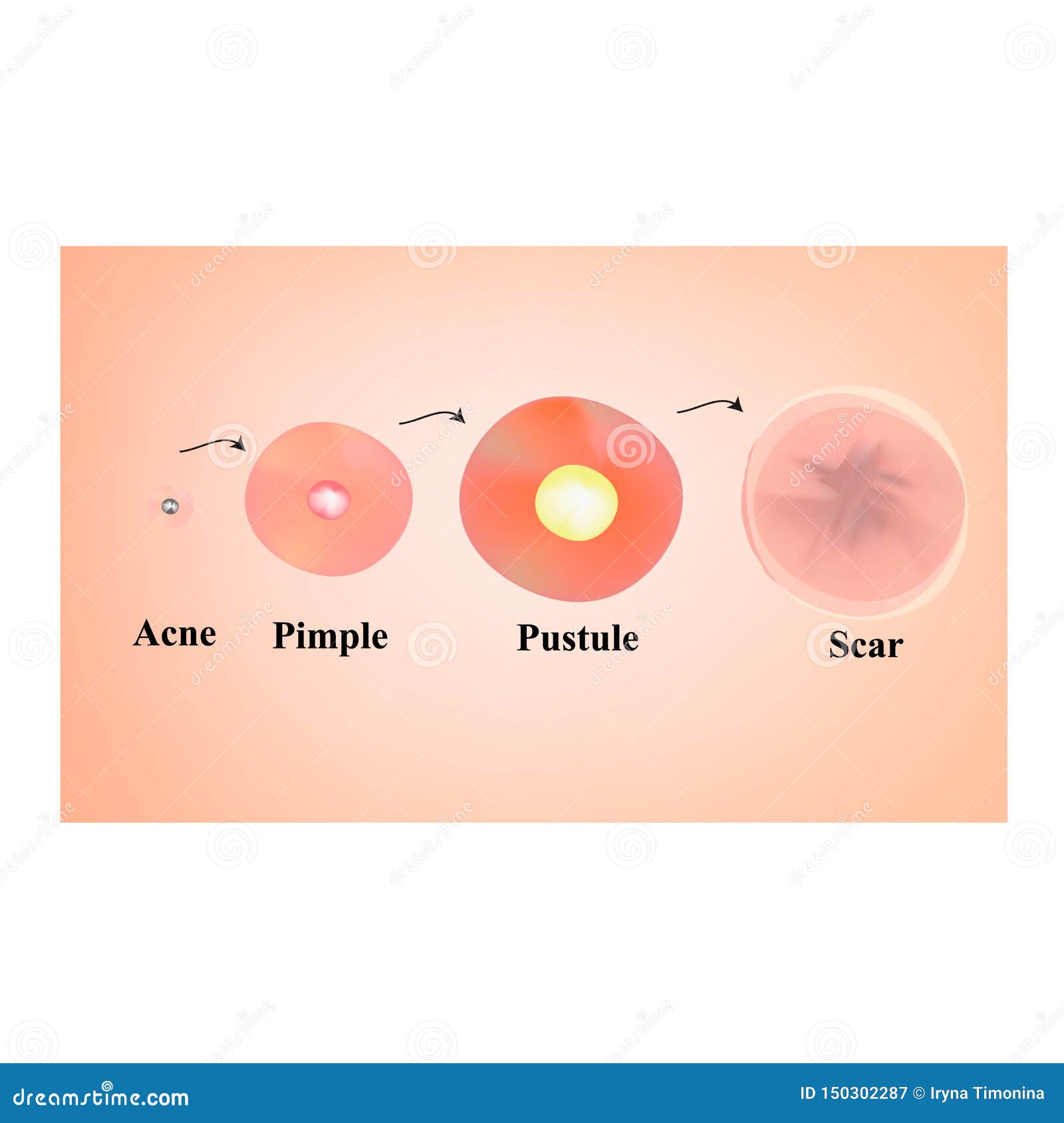 Types Of Blackheads Pustule Acne Scarred Skin After Acne And Acne
